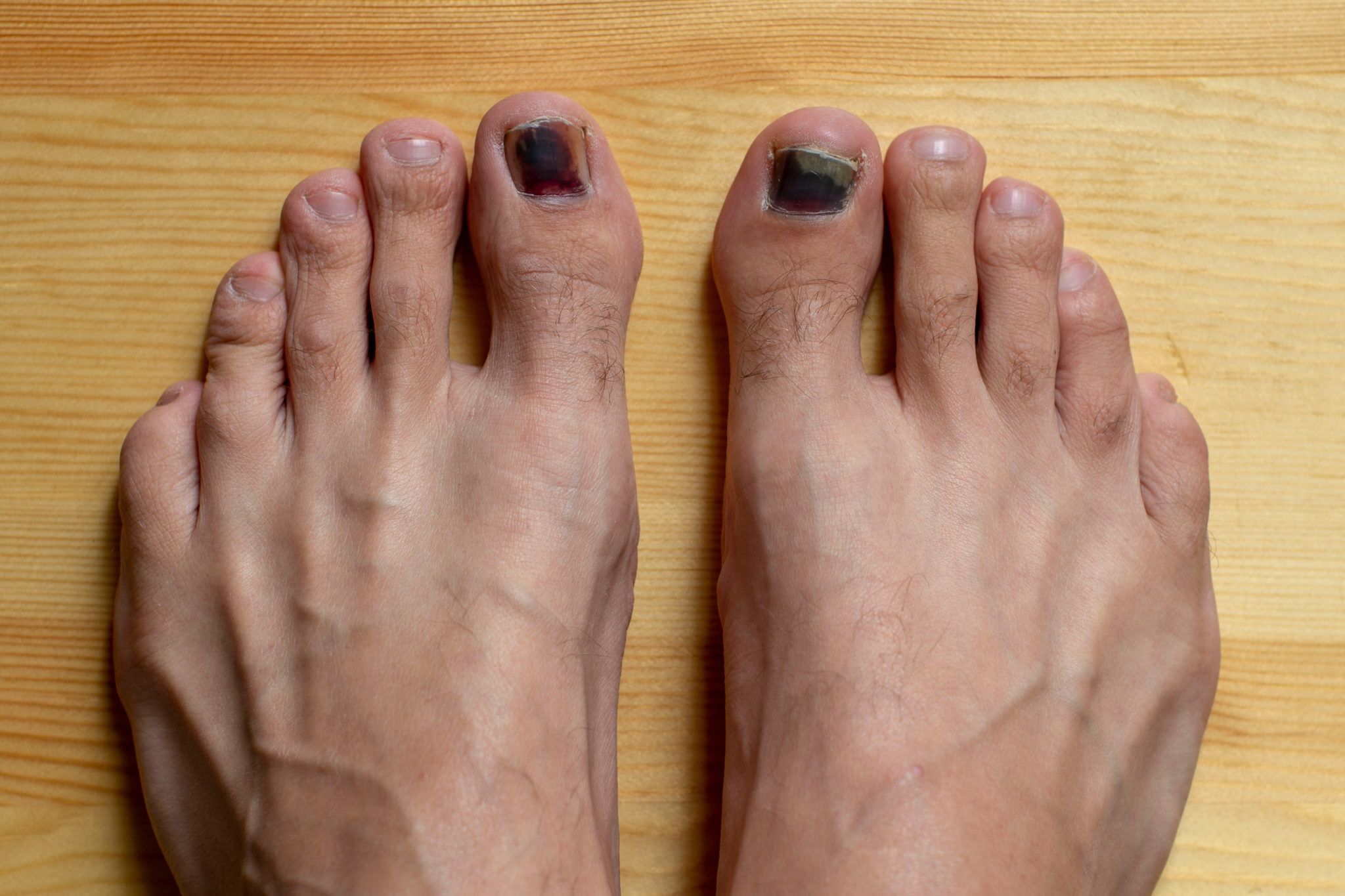 Toenail Falling Off The Secret Podiatrist Tip To Getting It To Grow Back